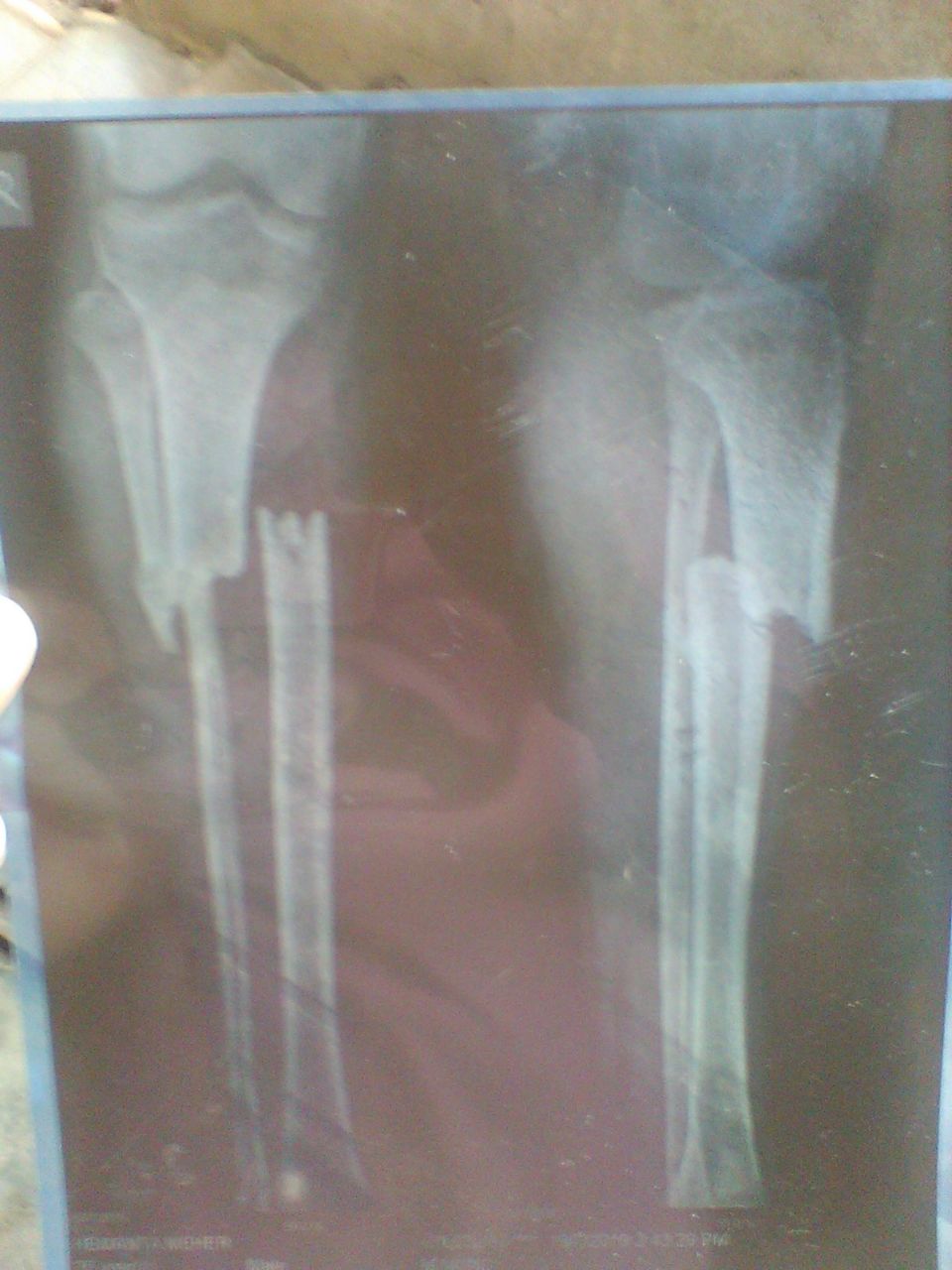 High caste Hindu with broken legs (see x-ray) miraculously healed ...